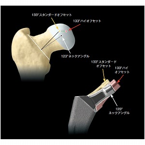 人工股関節 テーパーロック コンプリートXR123°ステム (製造販売企業:ジンマー バイオメット合同会社) | プロダクトデータベース ...
