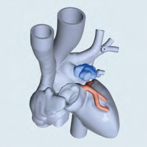 HEARTROID LAA Closure Model (製造販売企業:株式会社JMC) | プロダクトデータベース-メディカルオンライン-